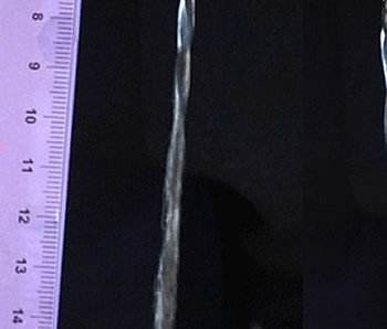 Shape of Urine Can Indicate Prostate Problems: QMUL School of ...